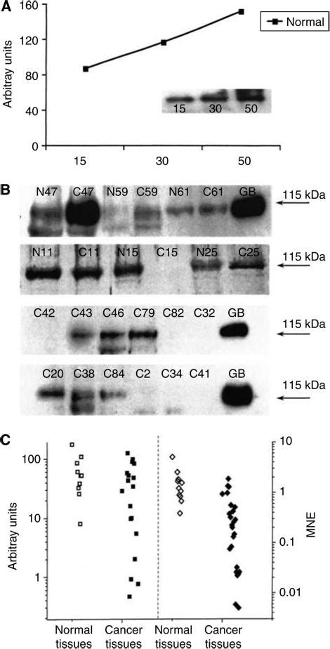 Pendrin Expression In Thyroid Tissues A Semiquantitative