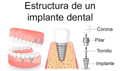 ¿qué Cuidados Debo Tener Después De Un Implante Dental Masquemedicos