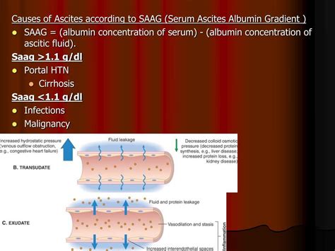 Ppt Ascites Abnormal Accumulation Of Fluid In The Peritoneal Cavity