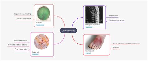 Osteomyelitis Causes Risk Factors And Spread