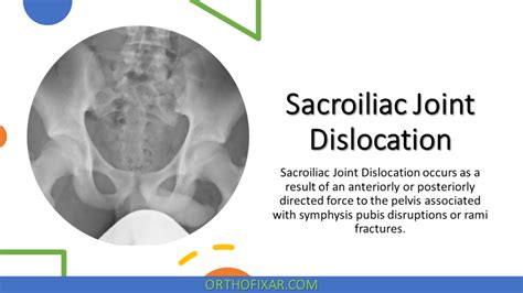Sacroiliac Joint Dislocation Full Review Orthofixar 2026