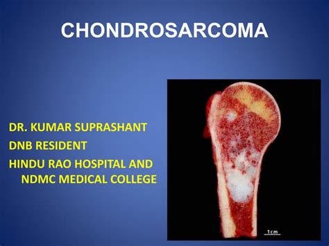 Chondrosarcoma Pptx