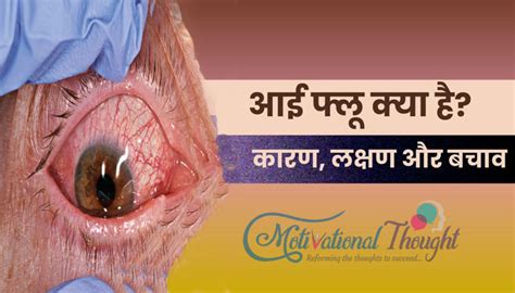 Eye Flu आई फ्लू क्या है जानें इसके लक्षण कारण बचाव और इलाज