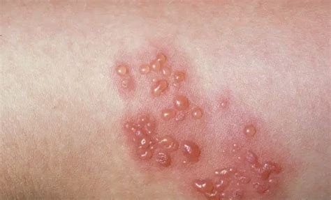 【皮肤健康】带状疱疹会传染，疼痛难以忍受，你做好这4点了吗