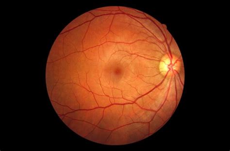 Retinal Imaging A Window To Early Disease Detection Optography