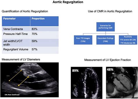 Eacvi Survey On Evaluation And Quantification Of Aortic Regurgitation By Multi Modality Imaging