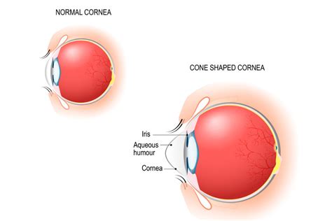 Keratoconus Good Vision For Life