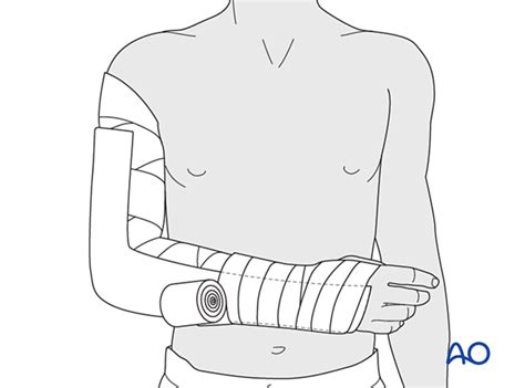Splint Immobilization For Avulsion Of Lateral Epicondyle