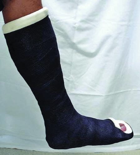 Short Leg Cast Wikism Sports Medicine Wiki