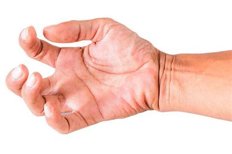 Pdf Intraoperative Manipulation For Flexion Contracture