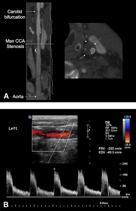 Ultrasound Diagnosis Of Carotid Artery Stenosis And Occlusion Dqusc