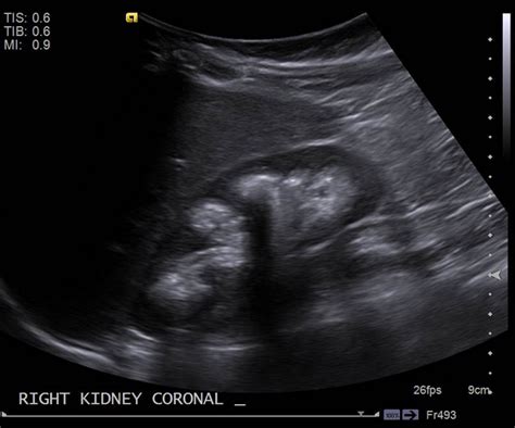 Renal Medullary Calcinosis