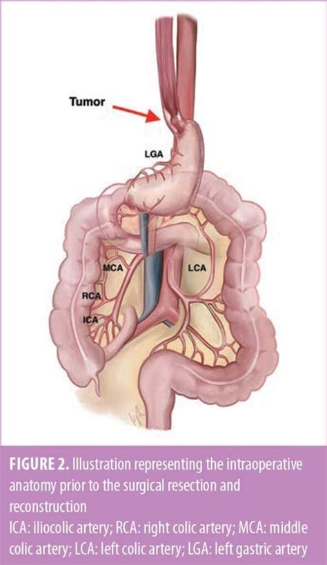 Colonic Interposition Graft As A Conduit Following Esophagectomy For