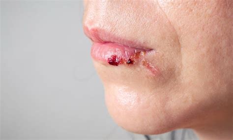 Simple Extraction Vs Surgical Extraction What Is The Difference