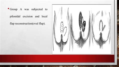 Surgical Treatment Of Pilonidal Disease Ppt