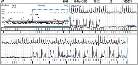Detection Of A Fast Ventricular Tachycardia Ventricular Fibrillation Download Scientific