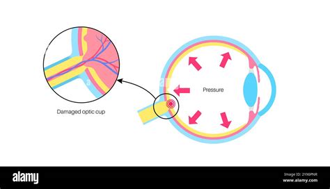 Glaucoma Diagram Cut Out Stock Images And Pictures Alamy