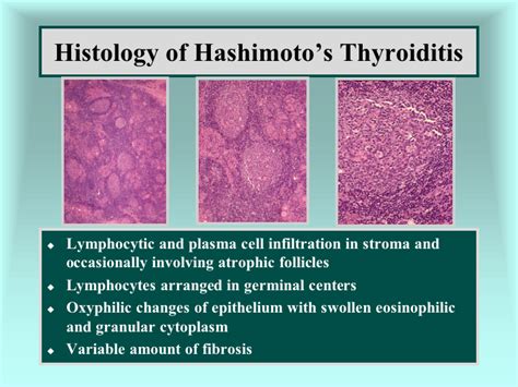 Hashimotos Thyroiditis Histology Pathology Of Thyroid And Endocrine