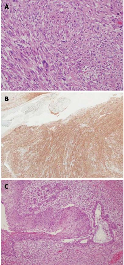 Pathologic Images A Pleomorphic Spindle Cells Showing Mitosis And Download Scientific Diagram
