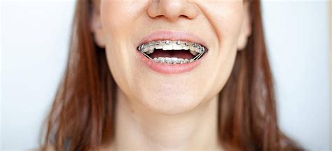 Braces Teeth Background Images Hd Pictures And Wallpaper For Free