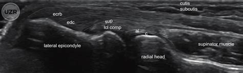 Abbildung 6 Lateraler Longitudinalschnitt B Mode Normalbefund Ecrb