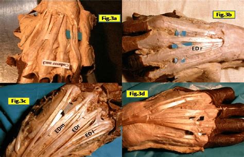 Extensor Indicis Cadaver