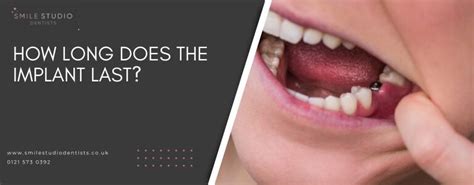 How Long Do Dental Implants Last Smile Studio Dentists