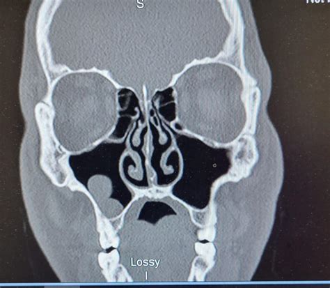 Here Is The Best Photo Of My Ct Scan What Do You Think Rsinusitis
