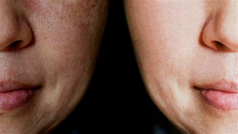 Melasma Balanced Management Treatment With Natural And Modern Methods