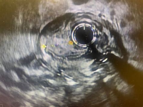 Rosario Ligresti Md Fasge On Linkedin First Case Today Was A 45 Yo Man