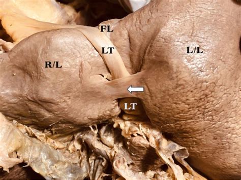Liver Ligamentum Teres And Interlobar Ligament Shown From The Visceral