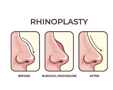Nose Surgery Specialist In India
