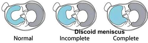 Discoid Meniscus Causes Symptoms Diagnosis Treatment And Prognosis