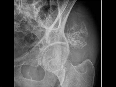 Musculoskeletal Bone Muscle Nerves And Other Soft Tissues 71 Bone Case 712 Exostosis