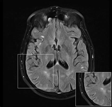 Abnormal Brain Mri