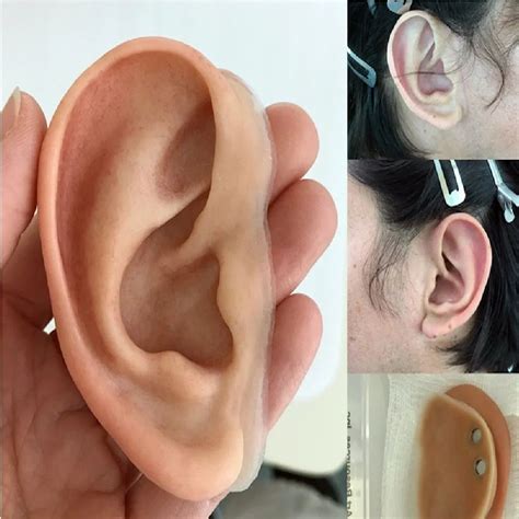 Silicone Ear Prosthesis At ₹ 30000 Silicone Ear Prosthesis In Kolkata