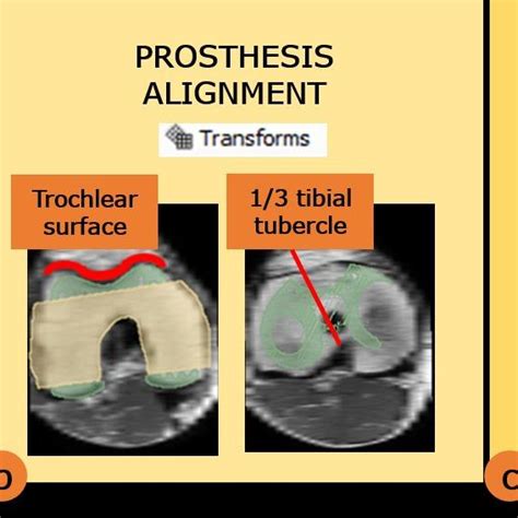The Analyzed Patient Presents A Normal Trochlear Surface Download