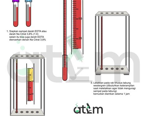Pemeriksaan Laju Endap Darah Led Metode Westergren Online Textbook Atlm Medical Laboratory