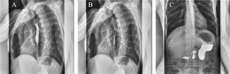 The Sign Of Esophageal Stenosis Was Seen On The Barium X Ray Ac The