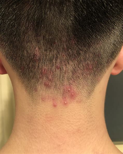 Folliculitis After Haircut Treatment Mrcq