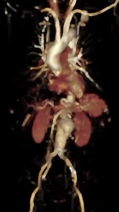 Successful Laser Fenestrated Evar Procedure An 80 Year Old Patient With A… Dr Abdullah A