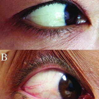 A Bluish Sclera With Peculiar Brilliancy And Pale Skin At