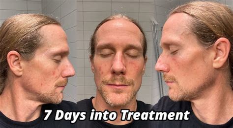 My Experience With Efudix Skin Cancer Cream The Raw Advantage