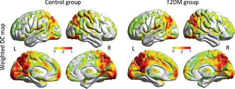 Figure 1 From Patients With Type 2 Diabetes Disrupted Brain Connectivity Patterns In Semantic
