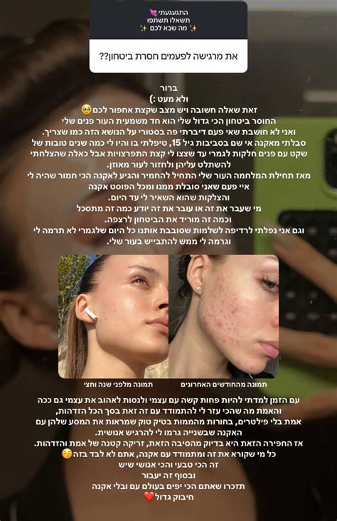 אנה זק משתפת חוסר הביטחון הכי גדול שלי הוא עור הפנים שלי