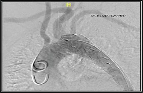 Intraoperative Angiogram After Stent Placement Download Scientific