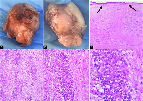 A And B Polypoid Mass C Stratified Squamous Epithelium Arrows Download Scientific