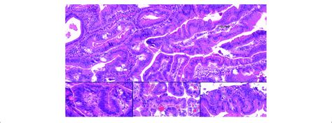 Representing The Combination Of Slit Like Serrations And Ectopic