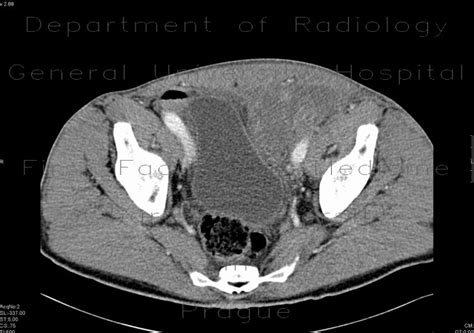 Radiology Case Hematoma After Repair Of Inguinal Hernia