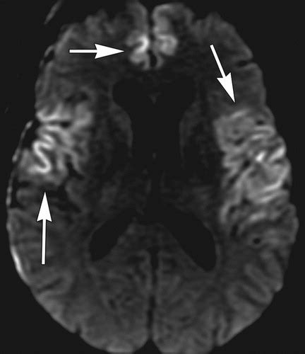 Neurocysticercosis Radiologic Pathologic Correlation Radiographics